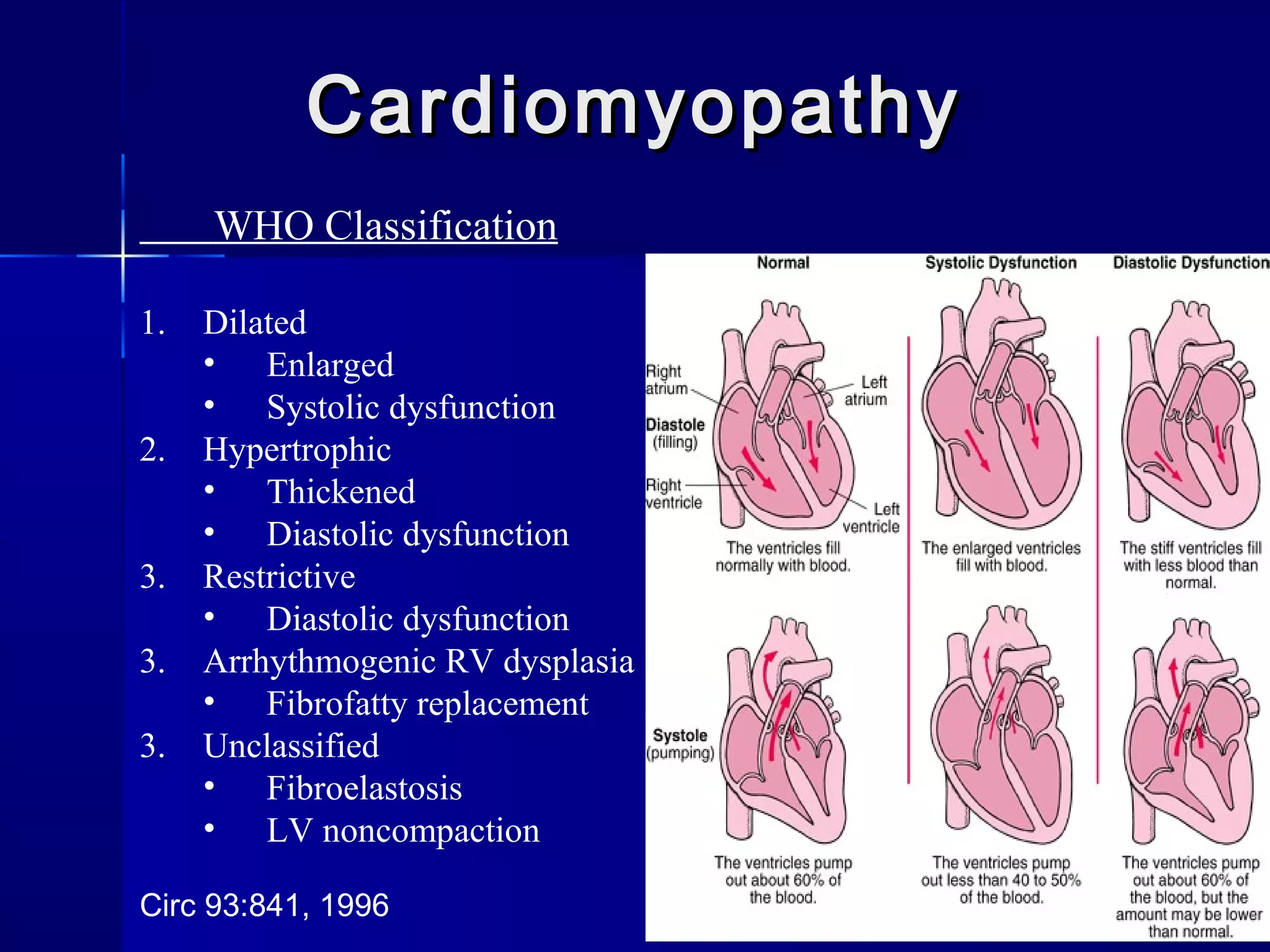 Approach to patient with Dilated Cardiomyopathy | PPT