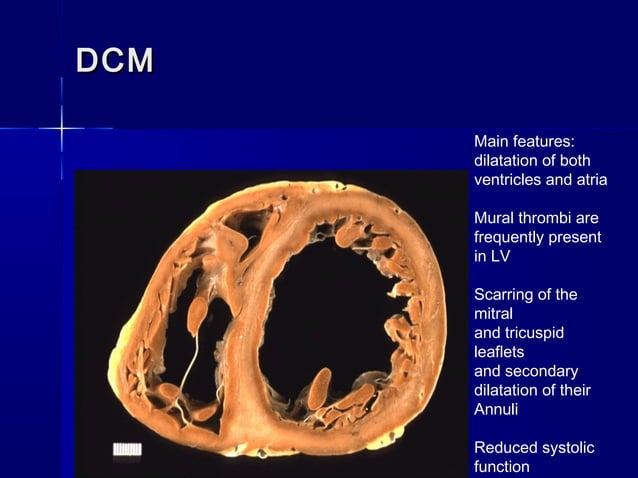 Approach to patient with Dilated Cardiomyopathy | PPT | Heart and ...