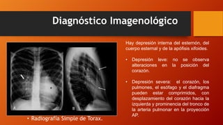 Corrección de Pectus Excavatum | PPTX