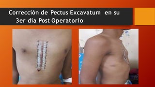 Corrección de Pectus Excavatum | PPTX