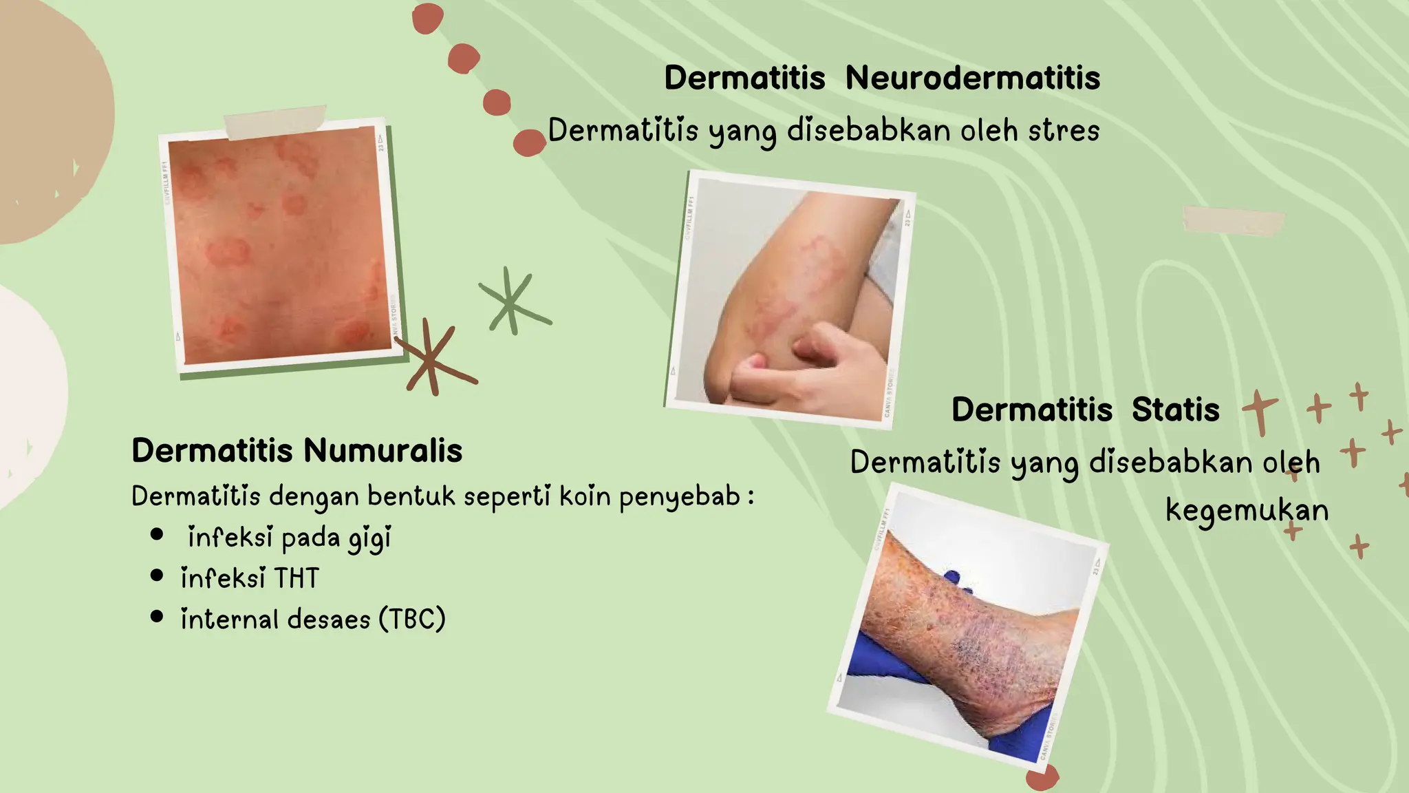 PPT DERMATITIS PKM.pdf