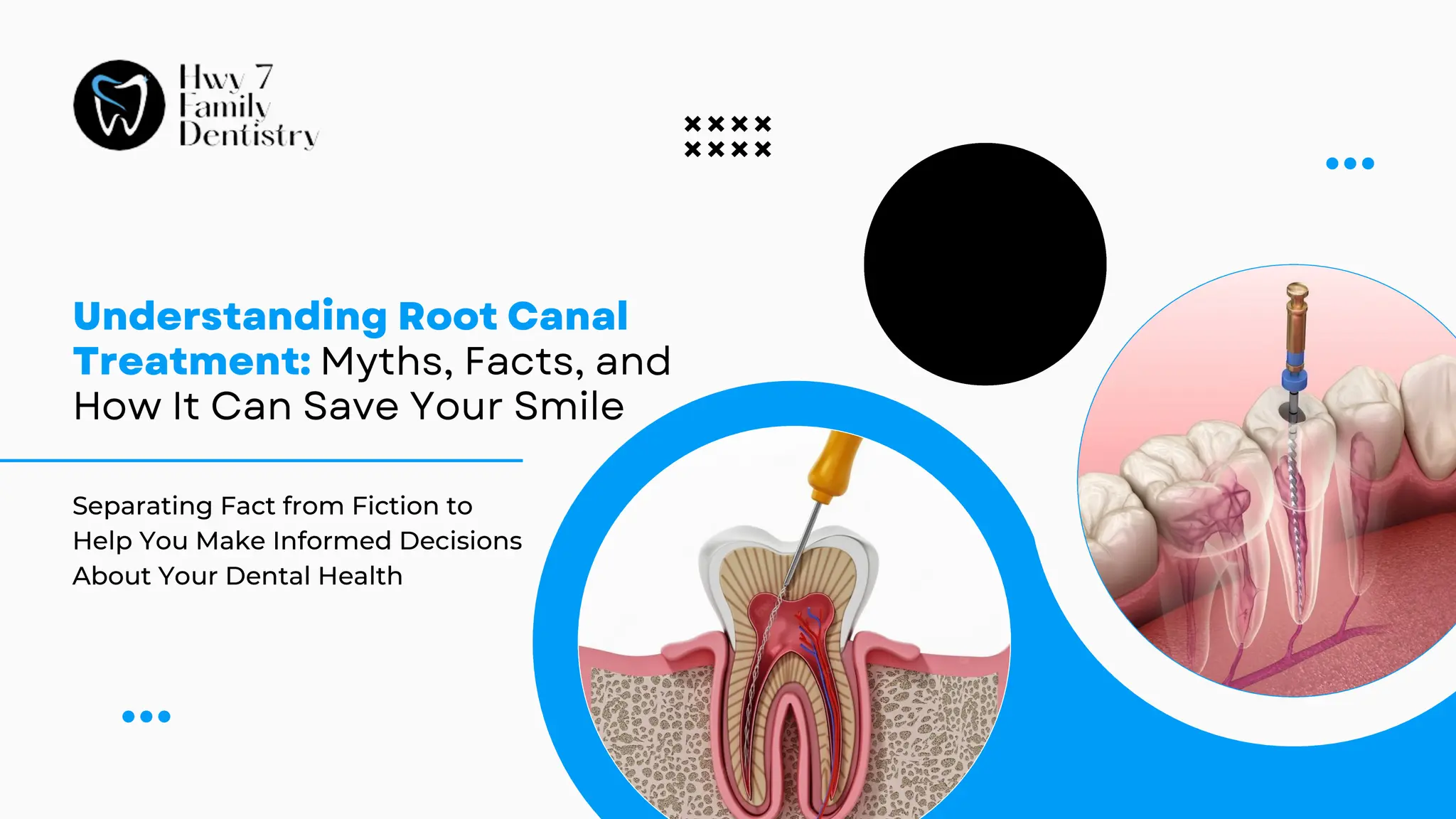 Understanding Root Canal Treatment: Myths, Facts, and How It Can Save ...