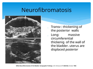 polypoid bladder mass in radiology point of view | PPTX