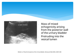 polypoid bladder mass in radiology point of view | PPTX