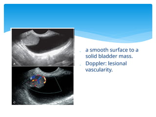 polypoid bladder mass in radiology point of view | PPTX
