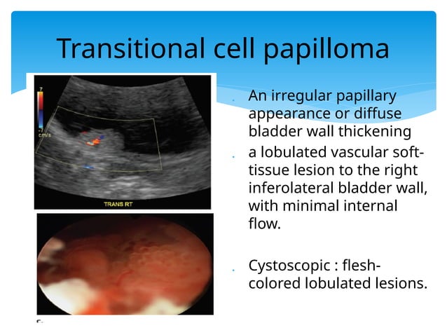 polypoid bladder mass in radiology point of view | PPT