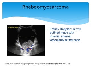 polypoid bladder mass in radiology point of view | PPTX