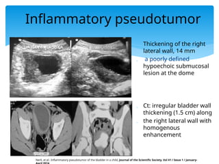 polypoid bladder mass in radiology point of view | PPT