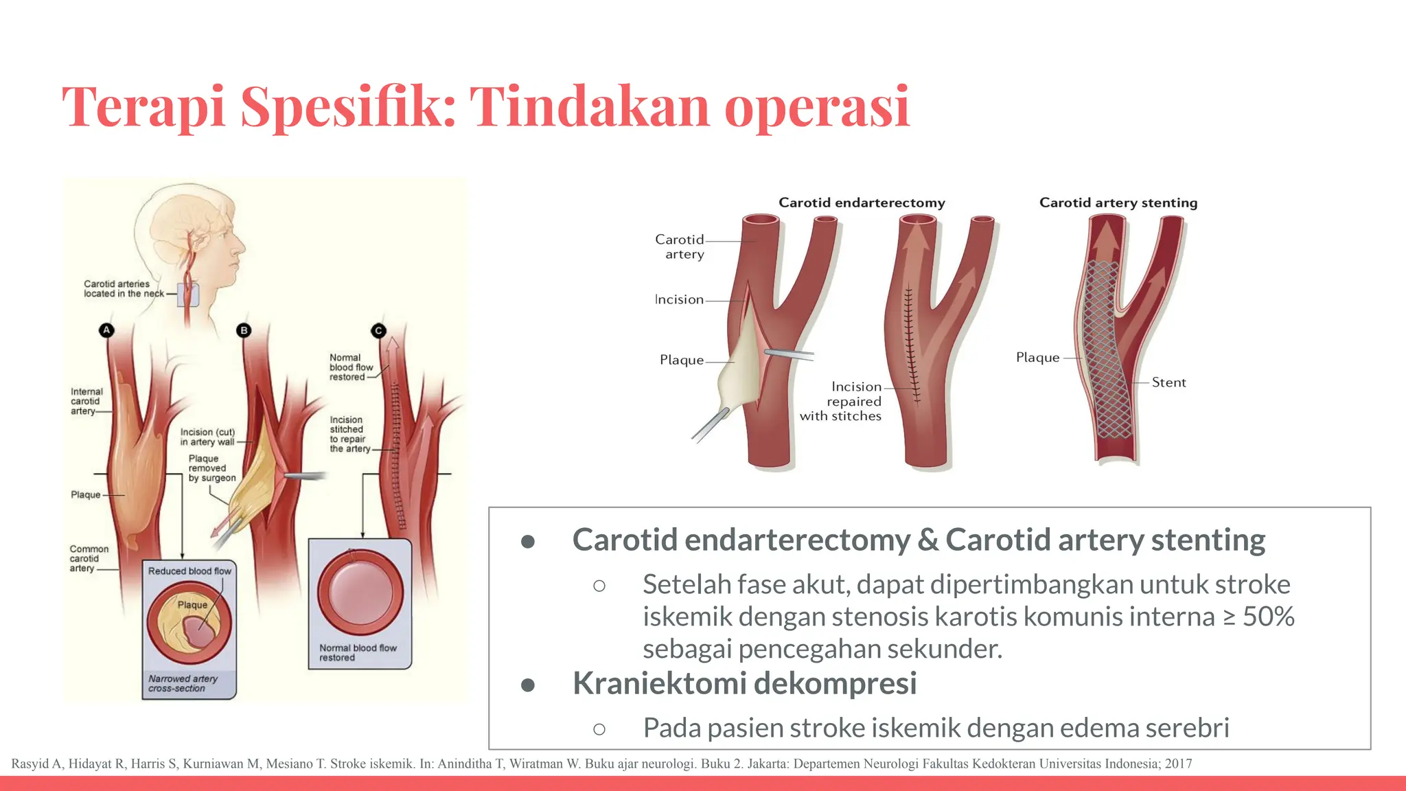 PPT Diskusi Topik - Stroke Iskemik (Rotasi G).pdf