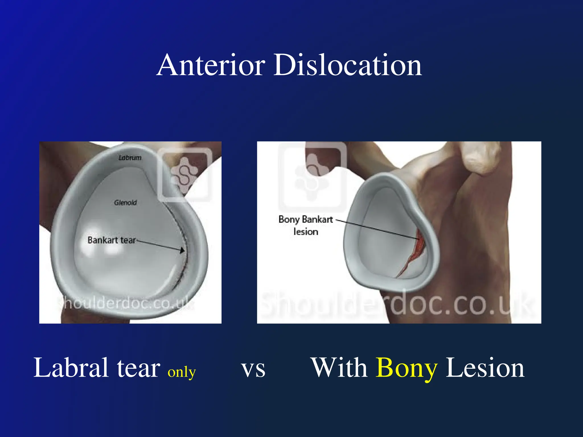 PPT Dislokasi Bahu Menurutu Hashem Bukhary.ppt