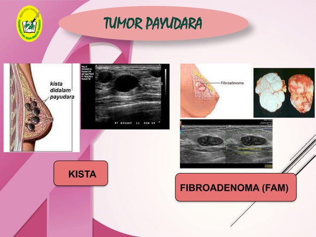 Skrinning dan deteksi dini kanker payudara.pptx