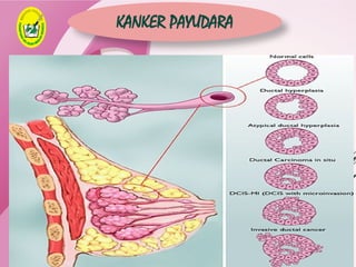 Skrinning dan deteksi dini kanker payudara.pptx