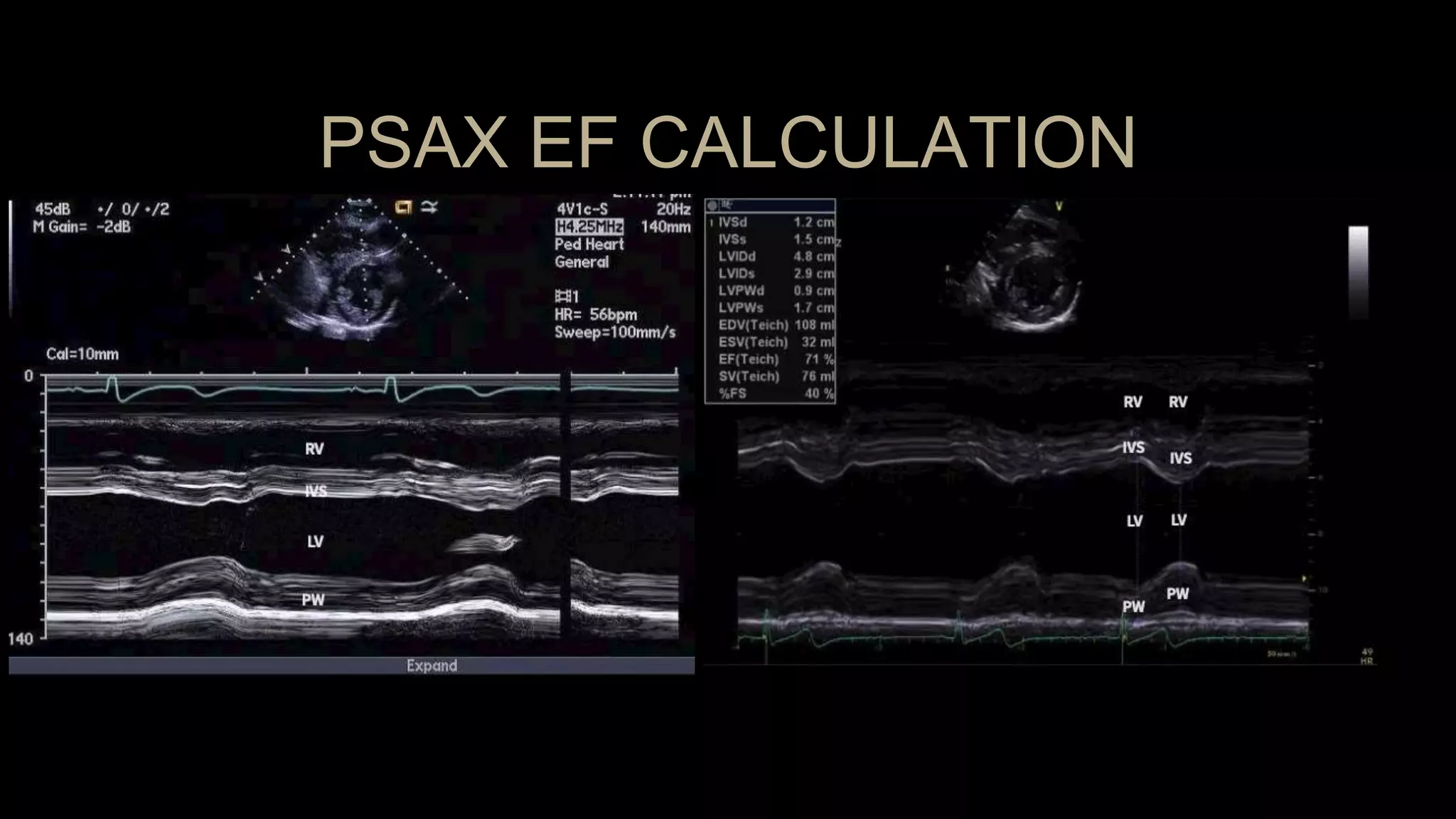 PEDIATRIC ECHOCARDIOGRAPHY: APICAL AND PARASTERNAL VIEWS | PPTX