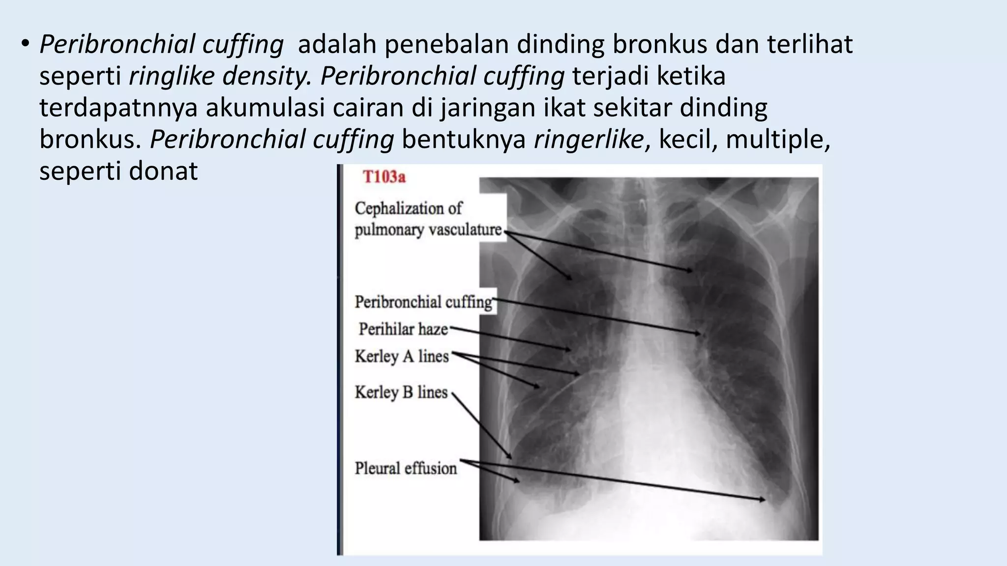 Ppt edema paru referat rifki | PPTX