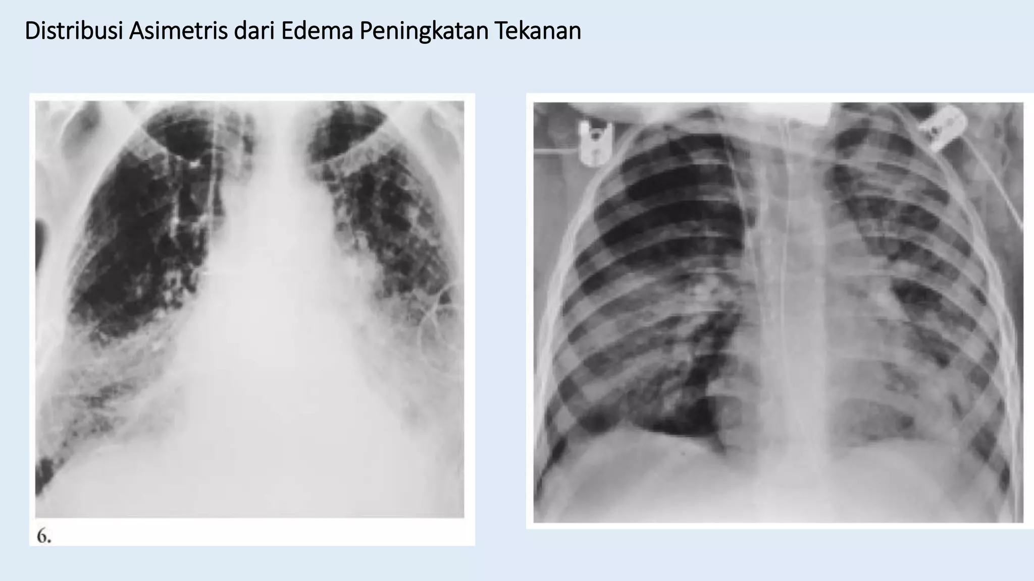 Ppt edema paru referat rifki | PPTX