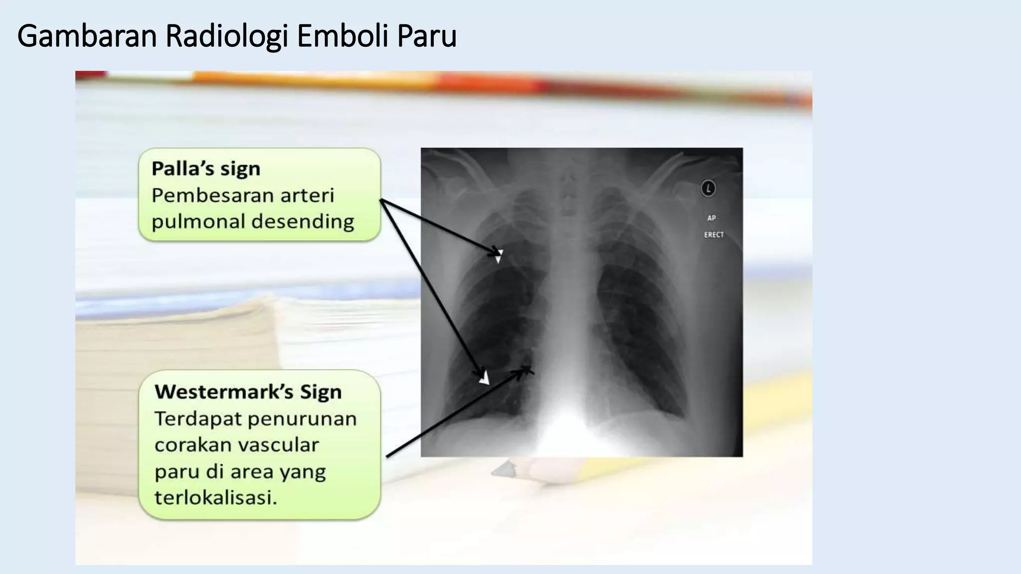 Ppt edema paru referat rifki | PPTX