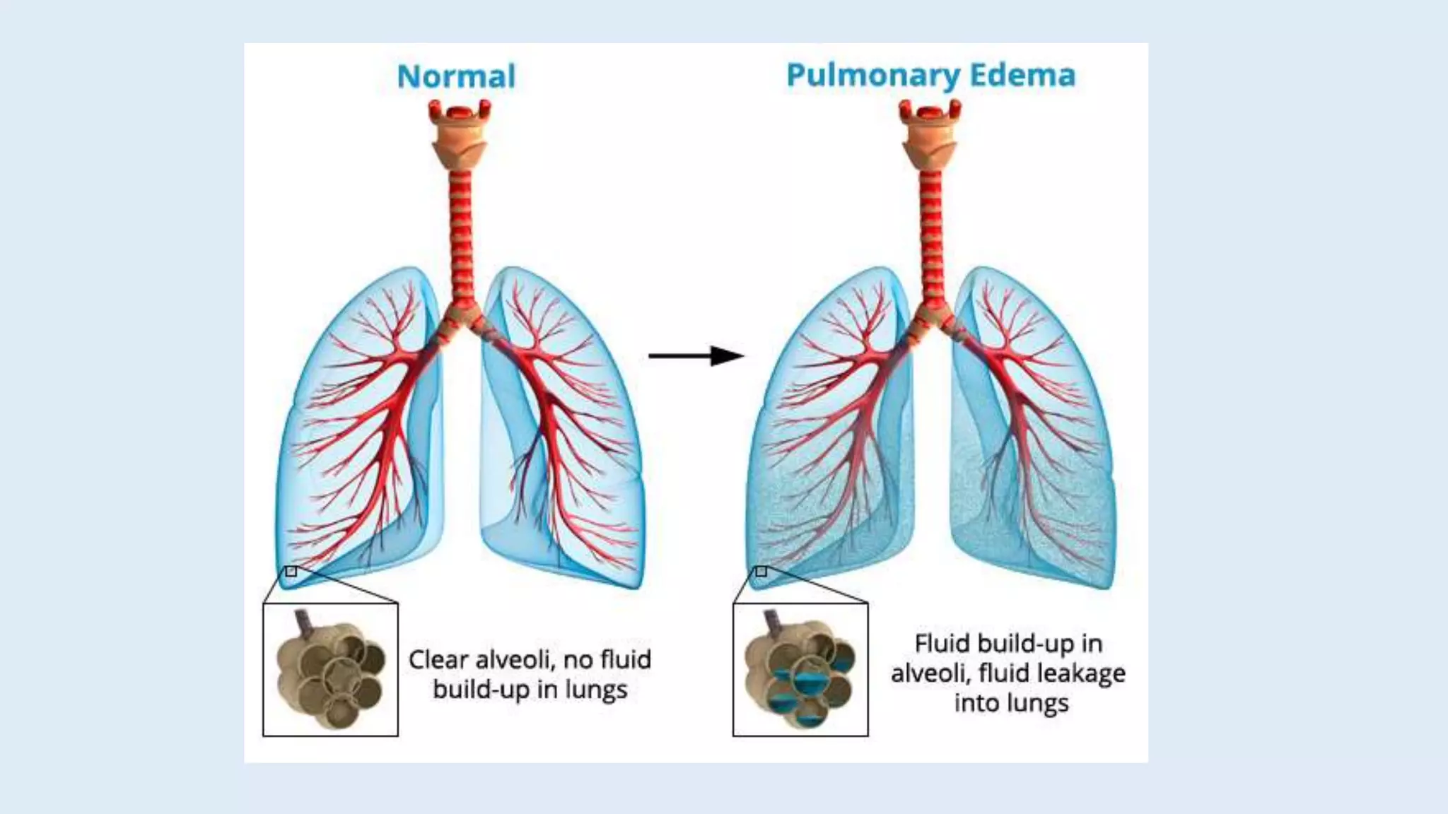 Ppt edema paru referat rifki | PPTX