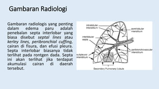Ppt edema paru referat rifki | PPTX