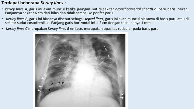 Ppt edema paru referat rifki | PPTX