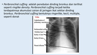 Ppt edema paru referat rifki | PPTX