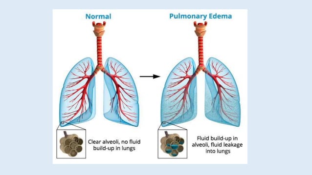 Ppt edema paru referat rifki | PPTX