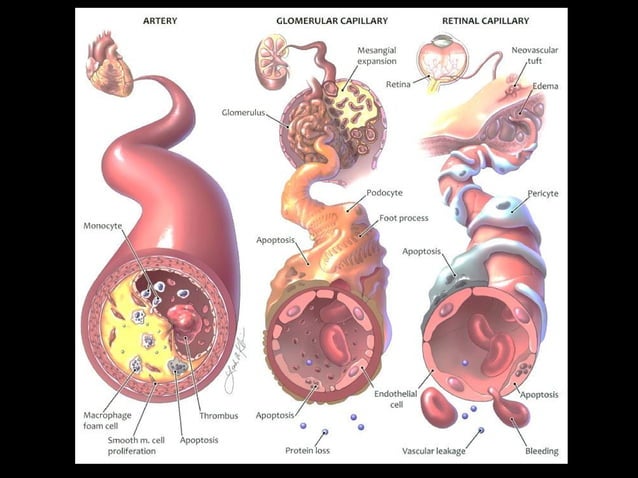bahaya diabetes melitus dn komplikasi nyapptx | PPT
