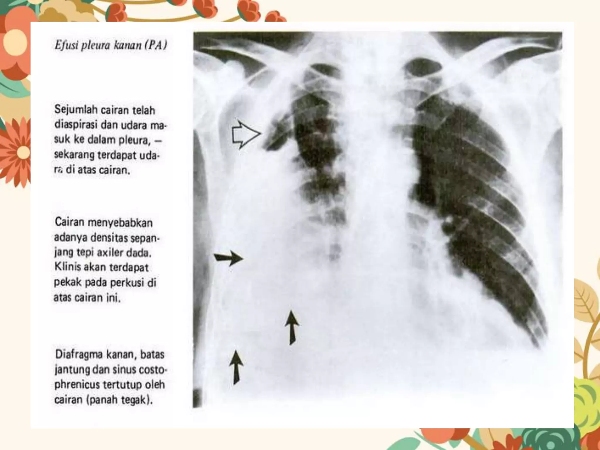 PPT Efusi Pleura | PPTX