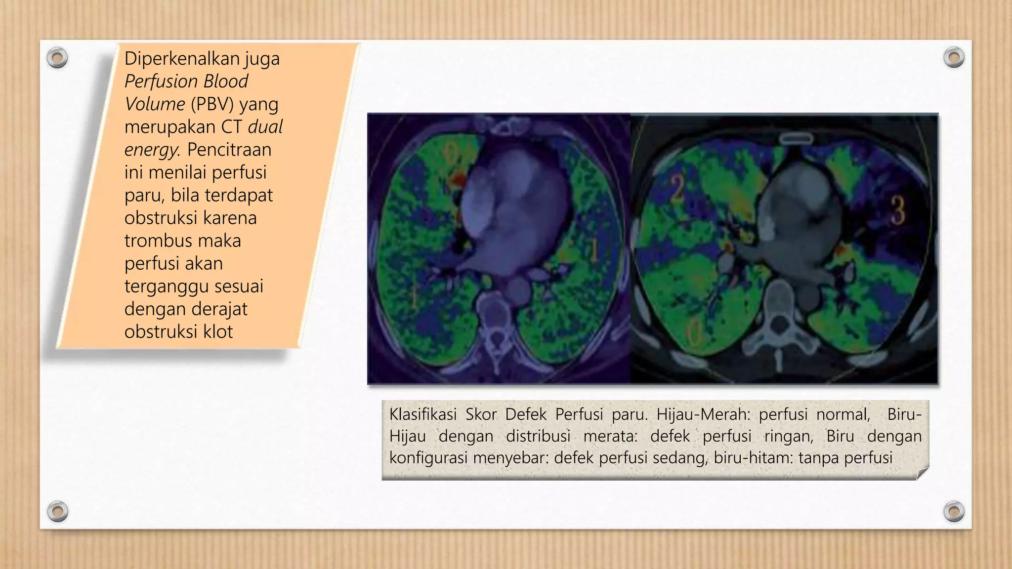 PPT_EMBOLI_PARU.pptx