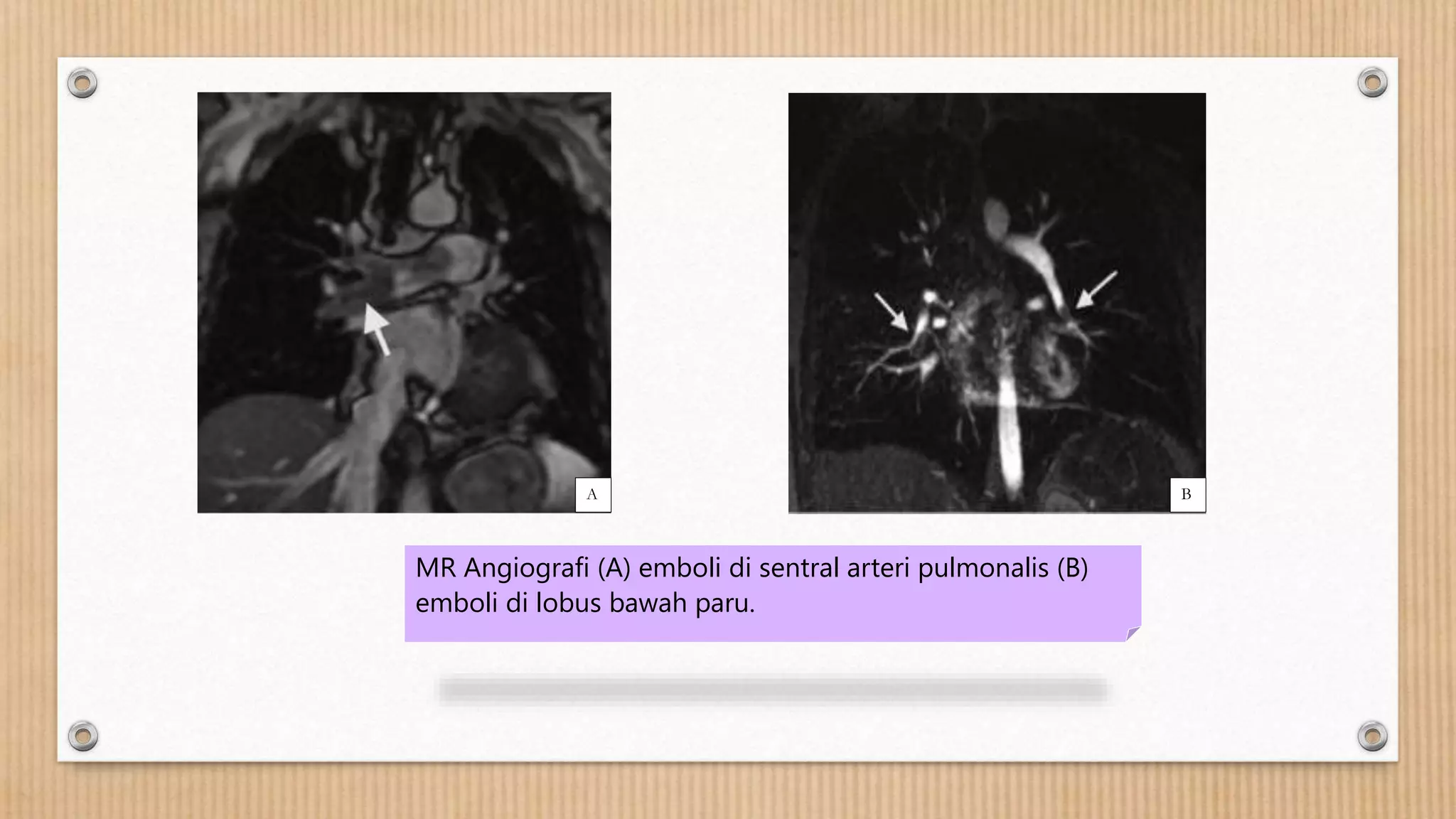 PPT_EMBOLI_PARU.pptx