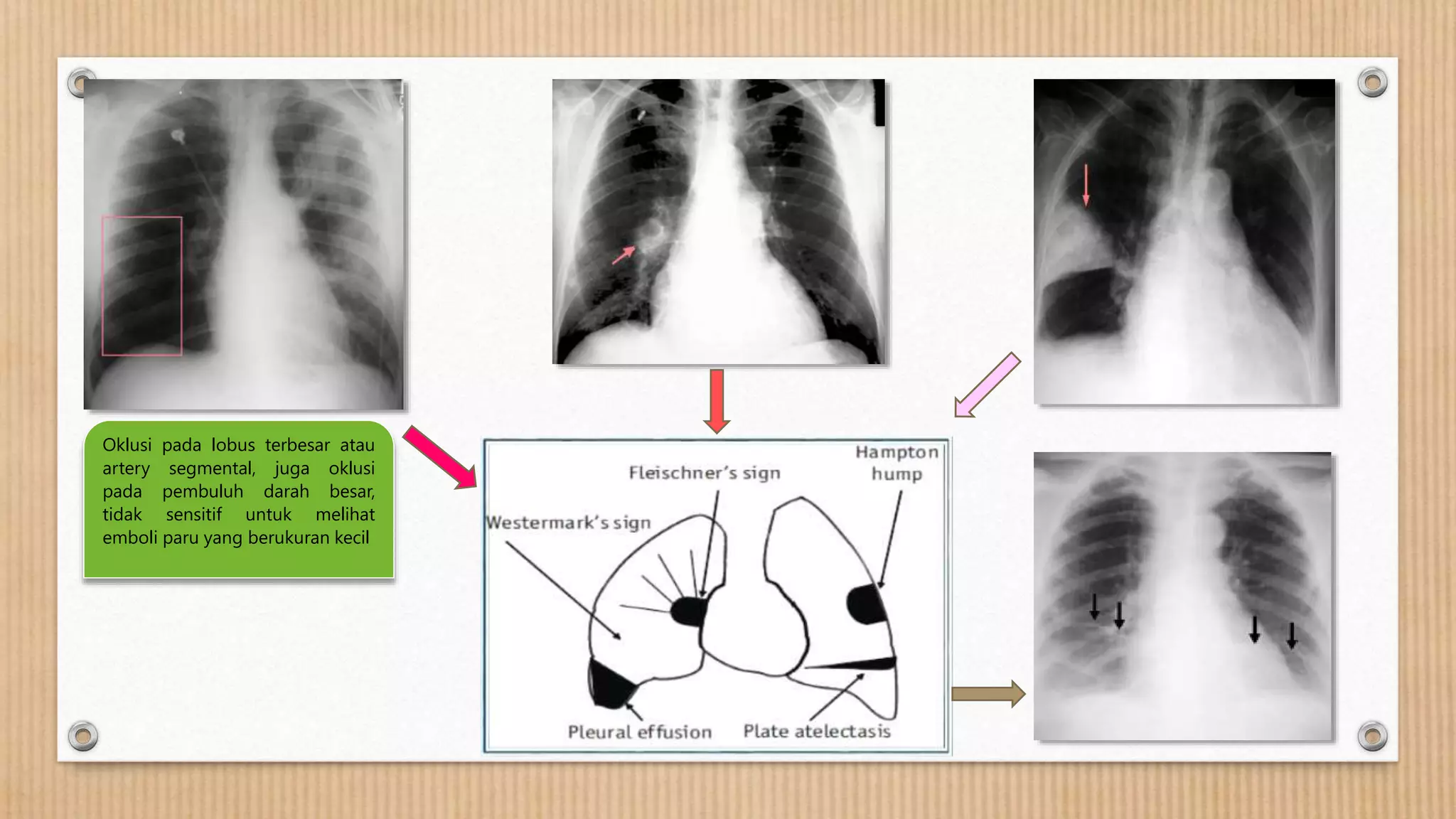 PPT_EMBOLI_PARU.pptx