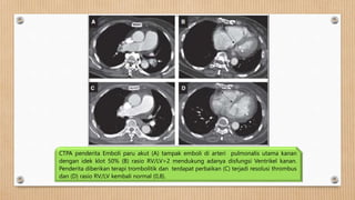 PPT_EMBOLI_PARU.pptx