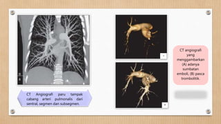 PPT_EMBOLI_PARU.pptx