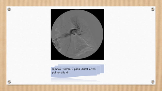PPT_EMBOLI_PARU.pptx