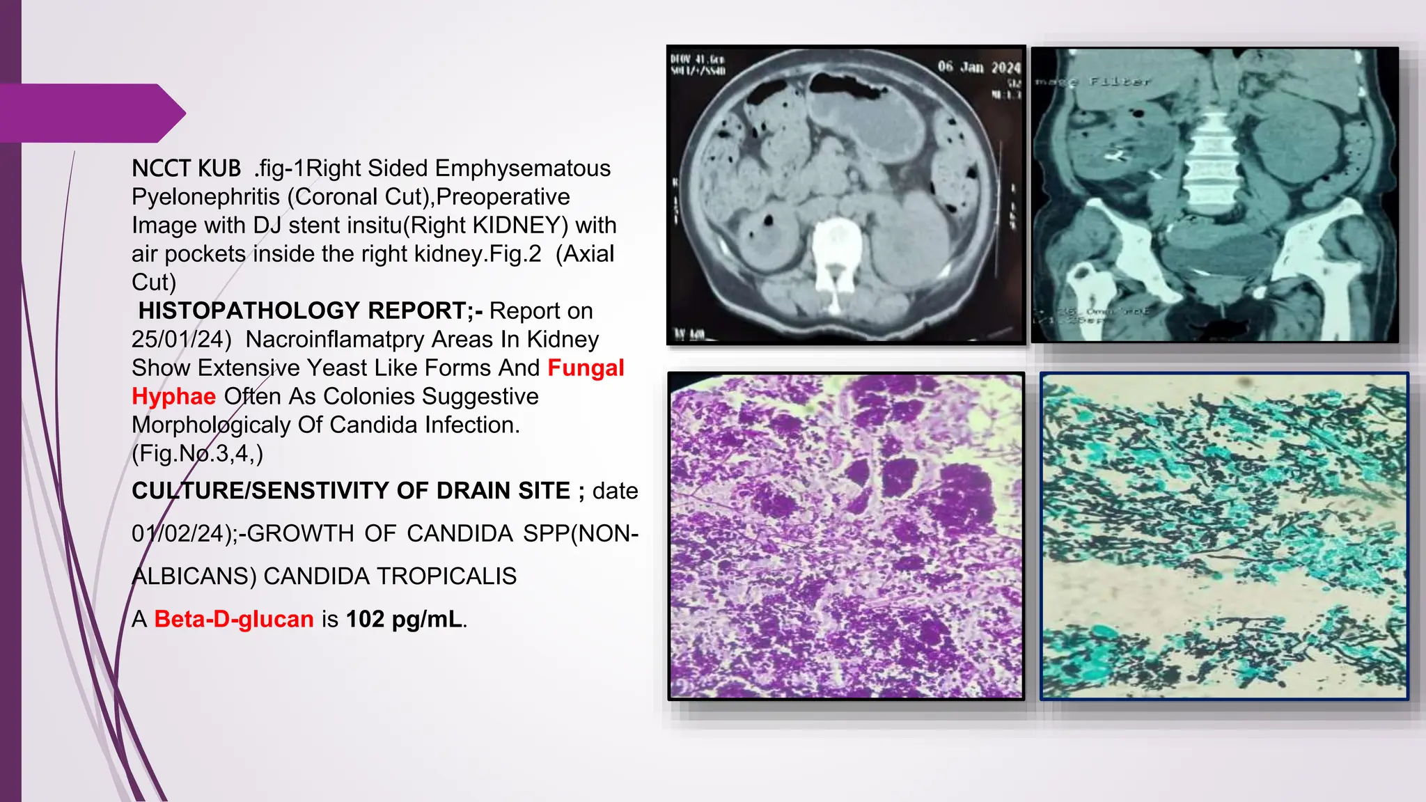 ppt emphysematous pyelonephritis due to fungal cause.pptx