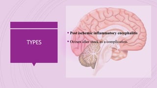 INFECTION OF THE BRAIN -ENCEPHALITIS ( PPT) | PPTX