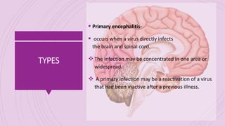 INFECTION OF THE BRAIN -ENCEPHALITIS ( PPT) | PPTX