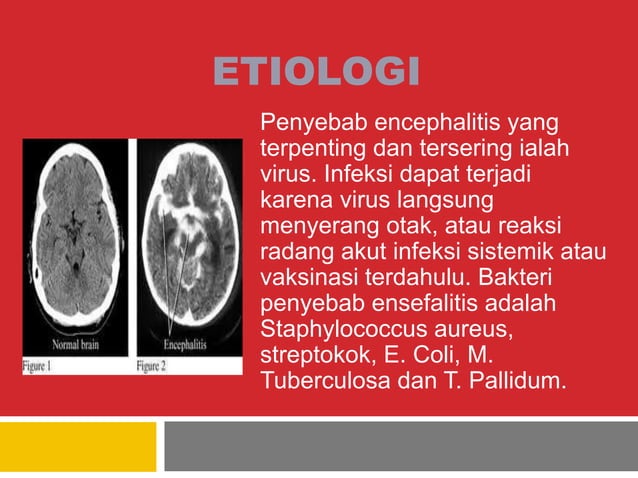 PPT ENCEPHALITIS kelompok 8.ppt