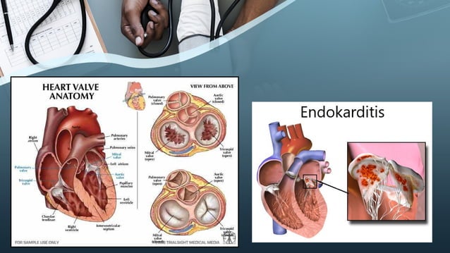 PPT ENDOKARDITIS.pptx SISTEMATIS CARDIOVASKULEER | PPTX