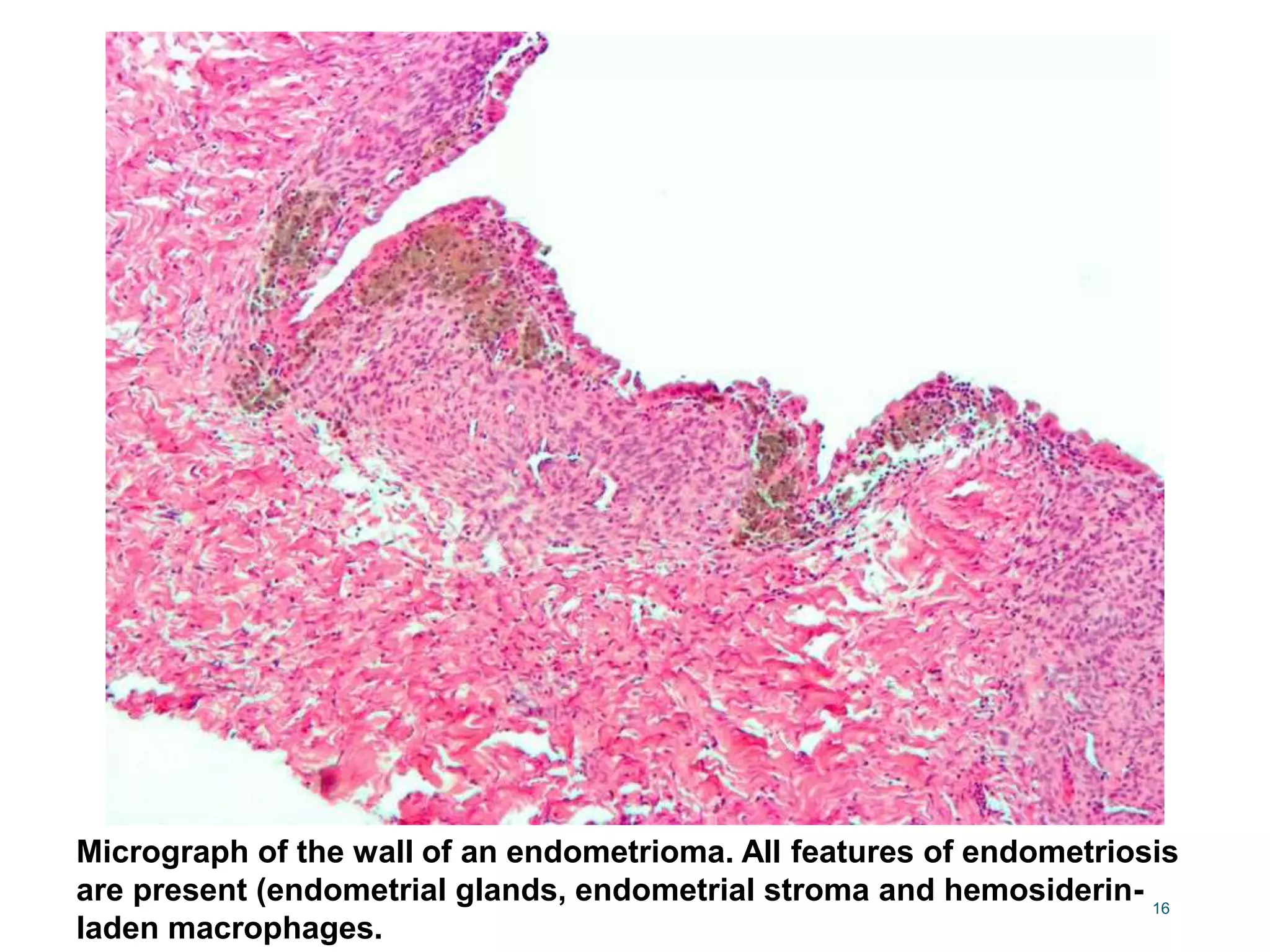 ppt endometriosis final year class.pptx