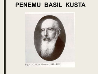 Ppt epidemiologi kusta | PPT