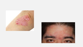 Eritroderma_Muhammad Fikri_ Perawatan meliputi tindakan suportif dan ...