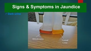 evaluation of jaundice | PPTX