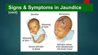 evaluation of jaundice | PPT