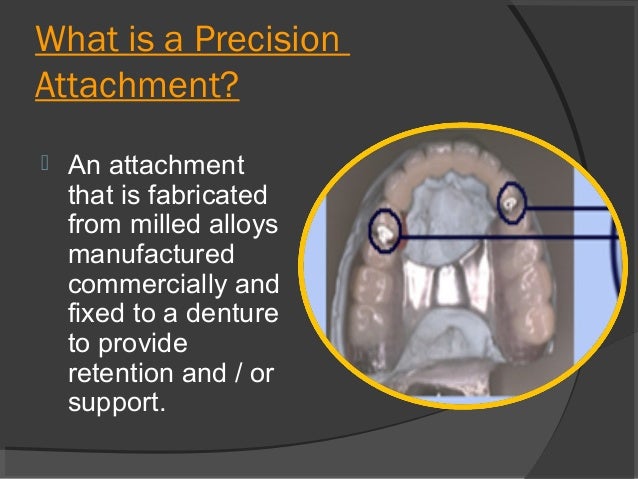 precision attachment in prosthodontics