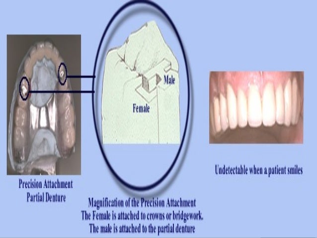 precision attachment in prosthodontics