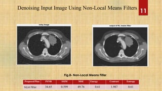 Lung Tumour Detection using Image Processing | PDF