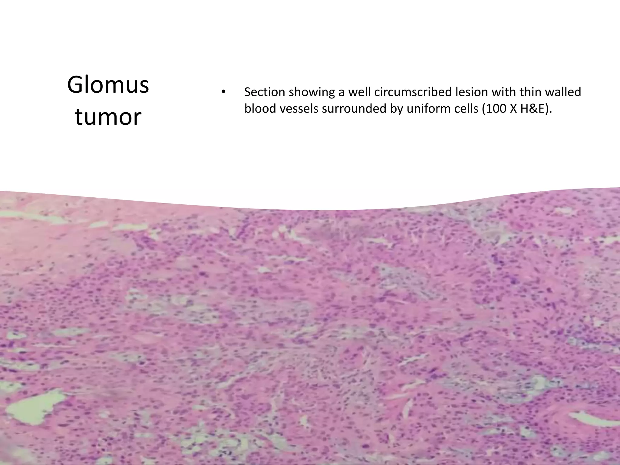 Ppt Glomus tumor of pulp of right middle finger | PPTX