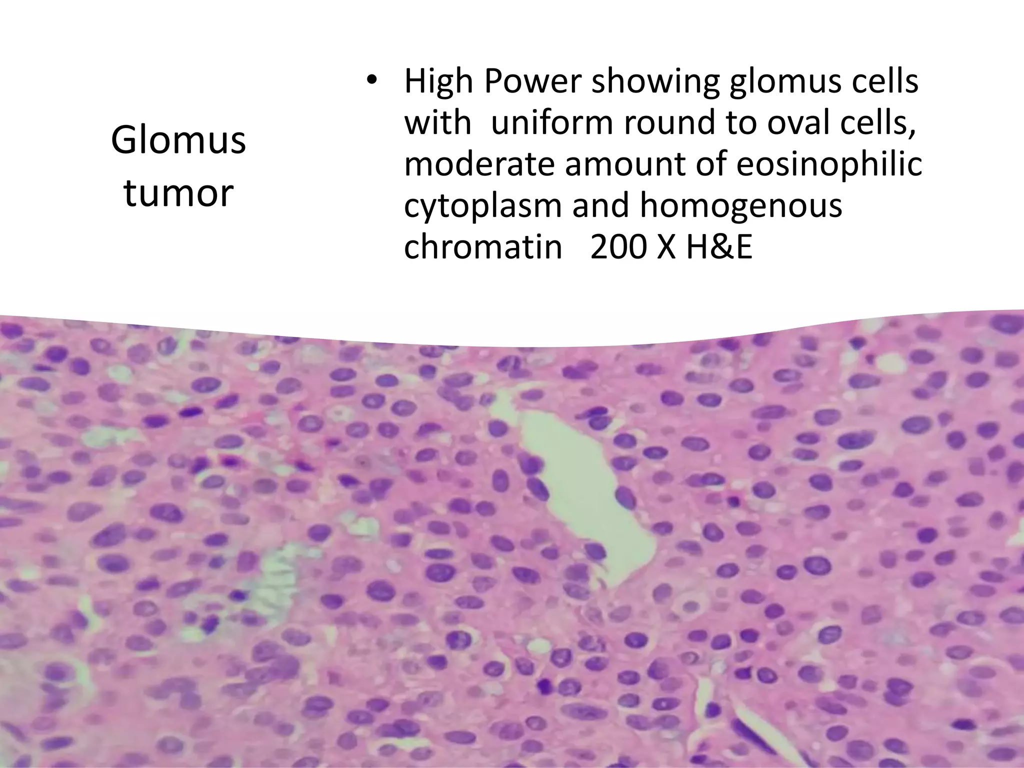 Ppt Glomus tumor of pulp of right middle finger | PPTX
