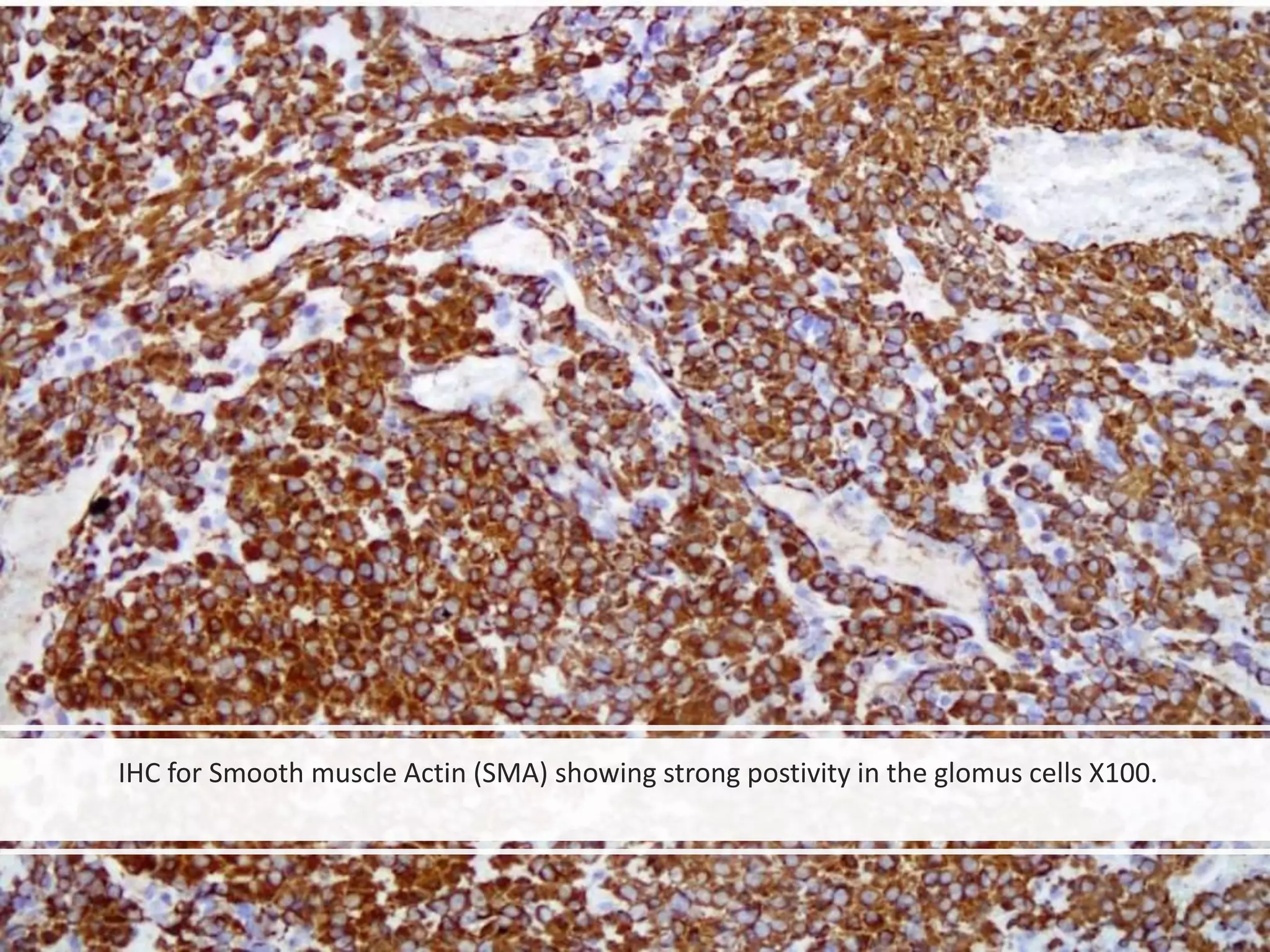Ppt Glomus tumor of pulp of right middle finger | PPTX