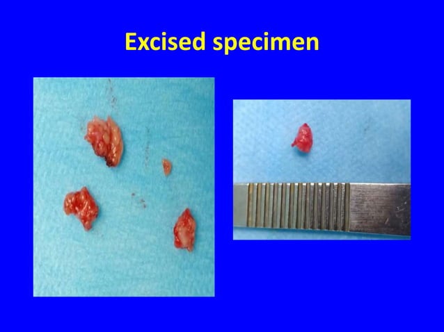 Ppt Glomus tumor of pulp of right middle finger | PPTX | Medical Tests ...